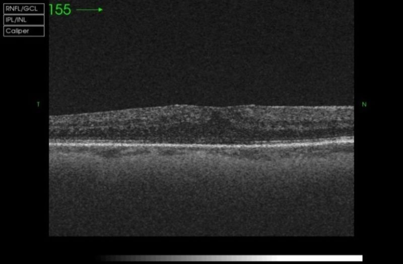 Macular Pucker – Vienna Clinical Trial Center