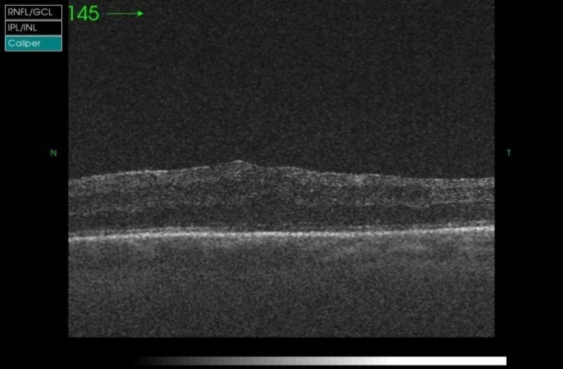 Macular Pucker – Vienna Clinical Trial Center
