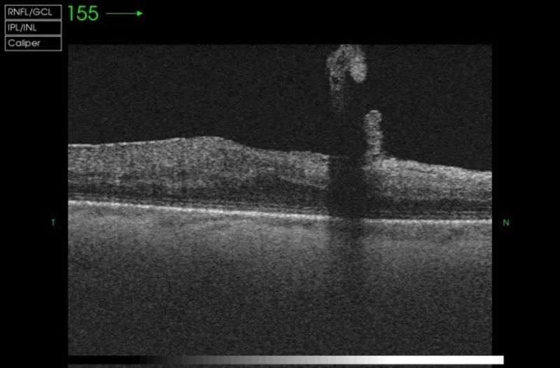 Macular Pucker – Vienna Clinical Trial Center