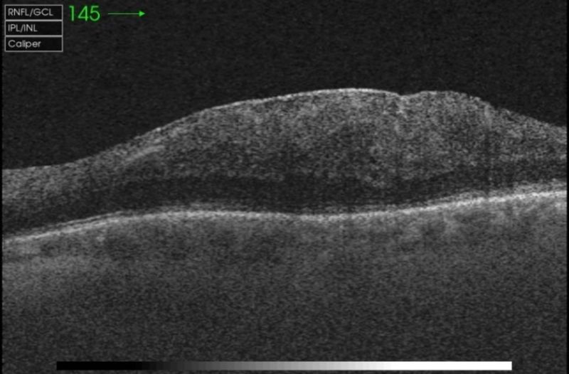 Macular Pucker – Vienna Clinical Trial Center